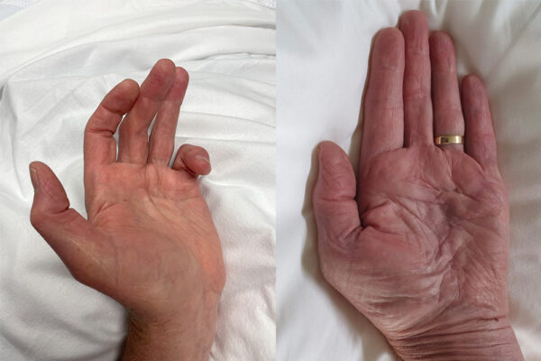 Dupuytren's Contracture Surgery NZ | Dupuytren's Disease