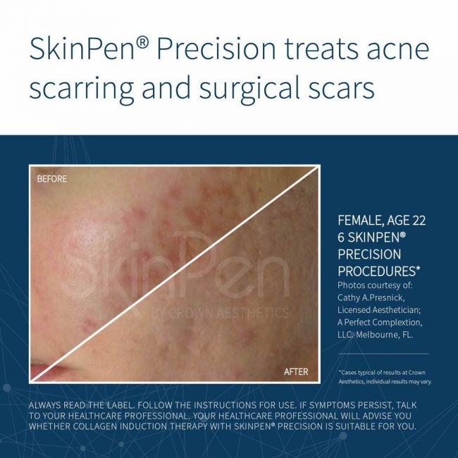 Rejuvenate Your Skin With SkinPen - Dr Anne Collins