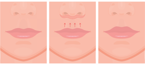Enhance Your Features With Upper Lip Lift - Dr Anne Collins