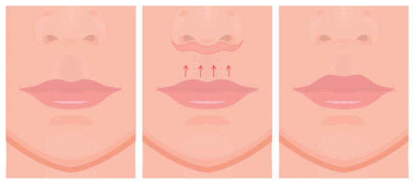 Transform Your Face With An Upper Lip Lift - Dr Anne Collins